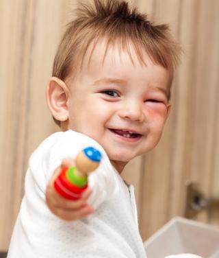 Si hay un chichón, dos días de observación | Las Provincias